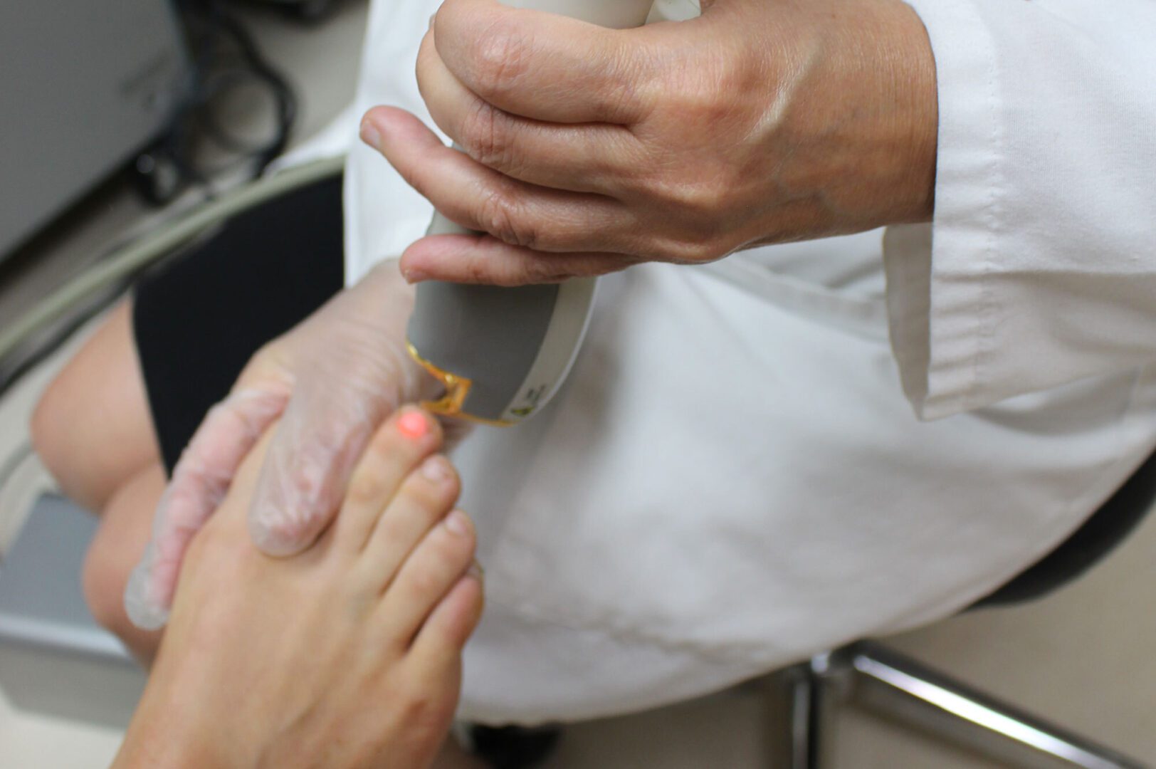 Laser Nail Fungus Removal